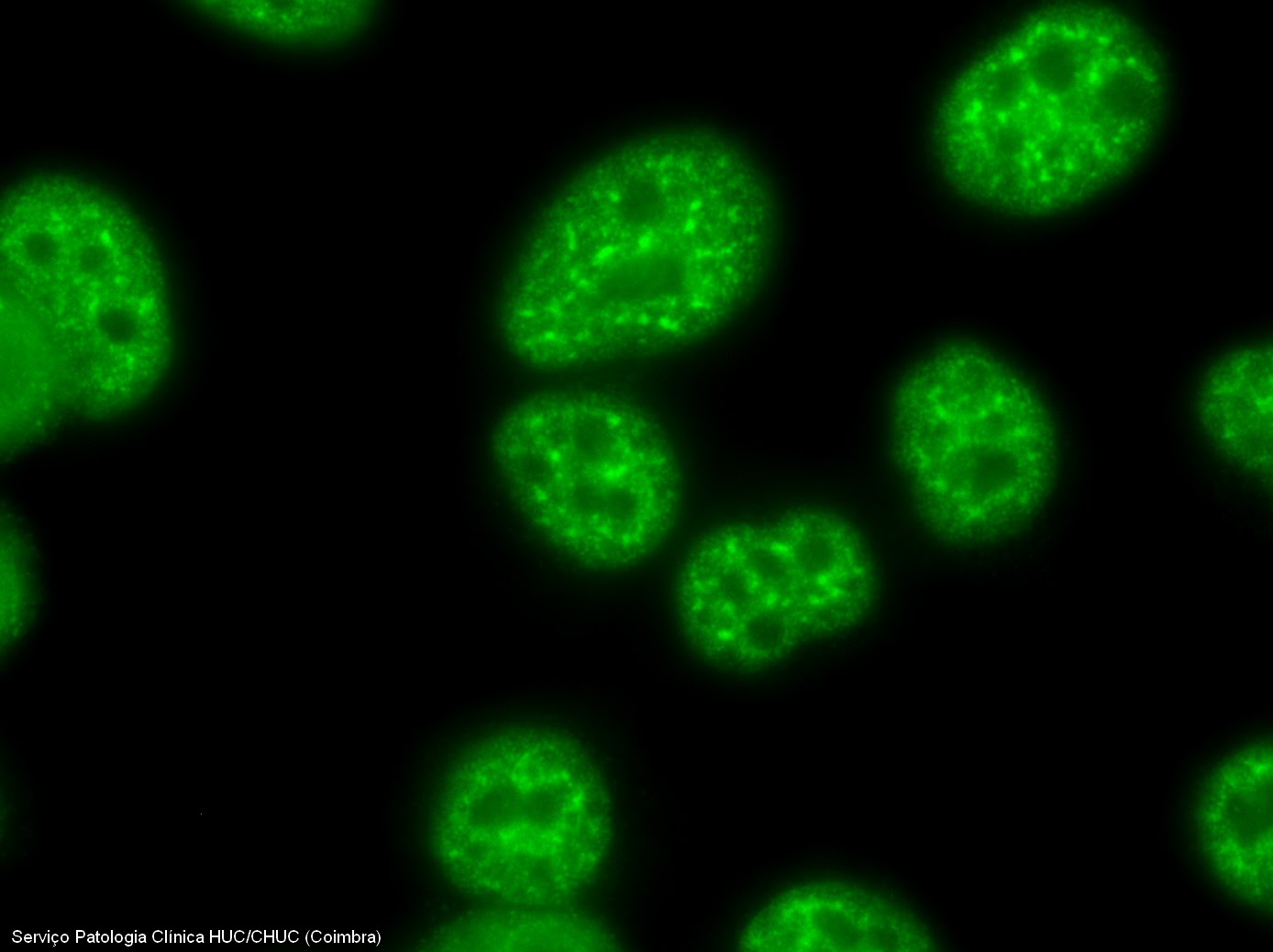 Anticorpos anti - Sm e anti - RNP