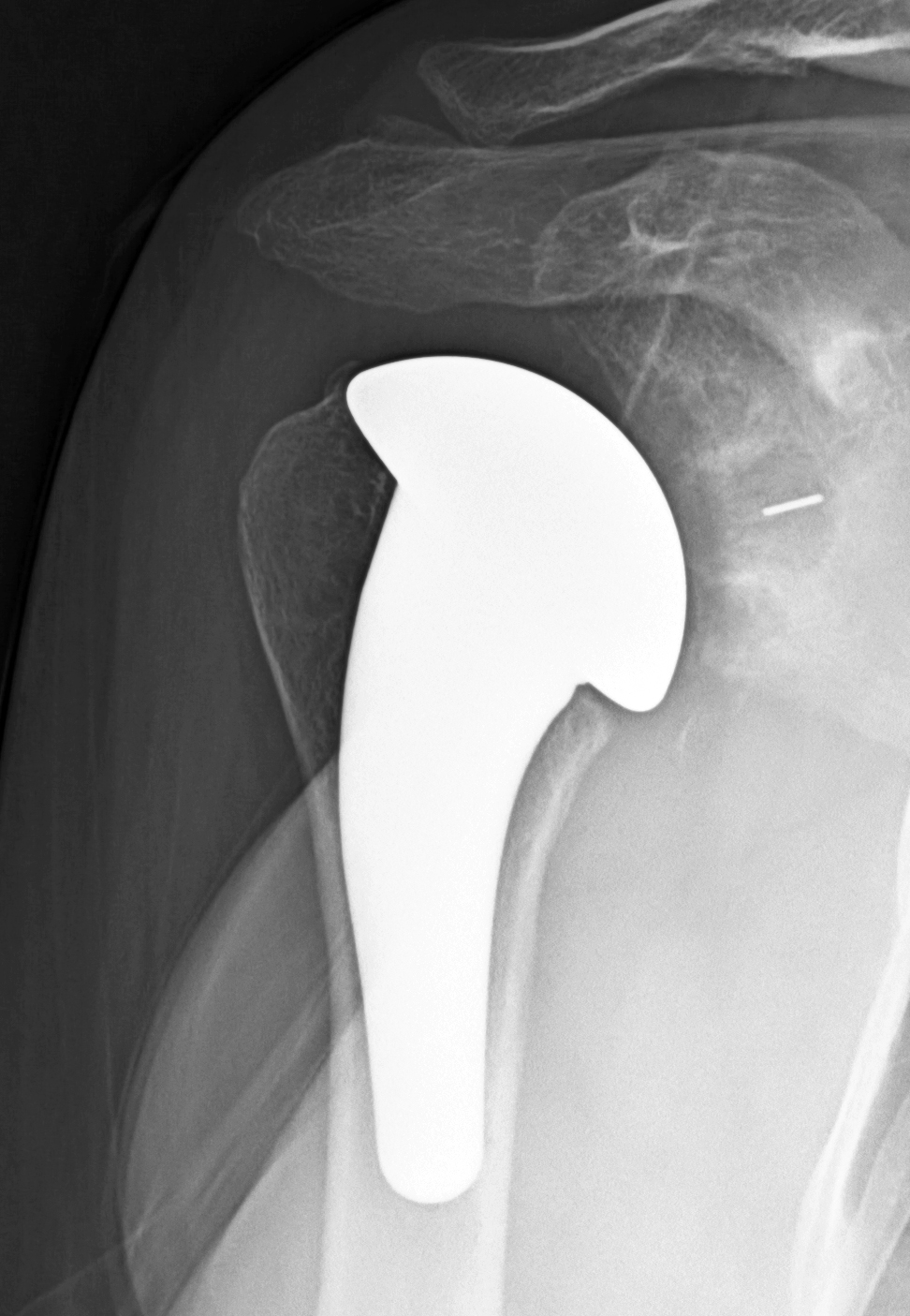 Shoulder Arthritis / Rotator Cuff Tears / Shoulder Pain : Short humeral ...