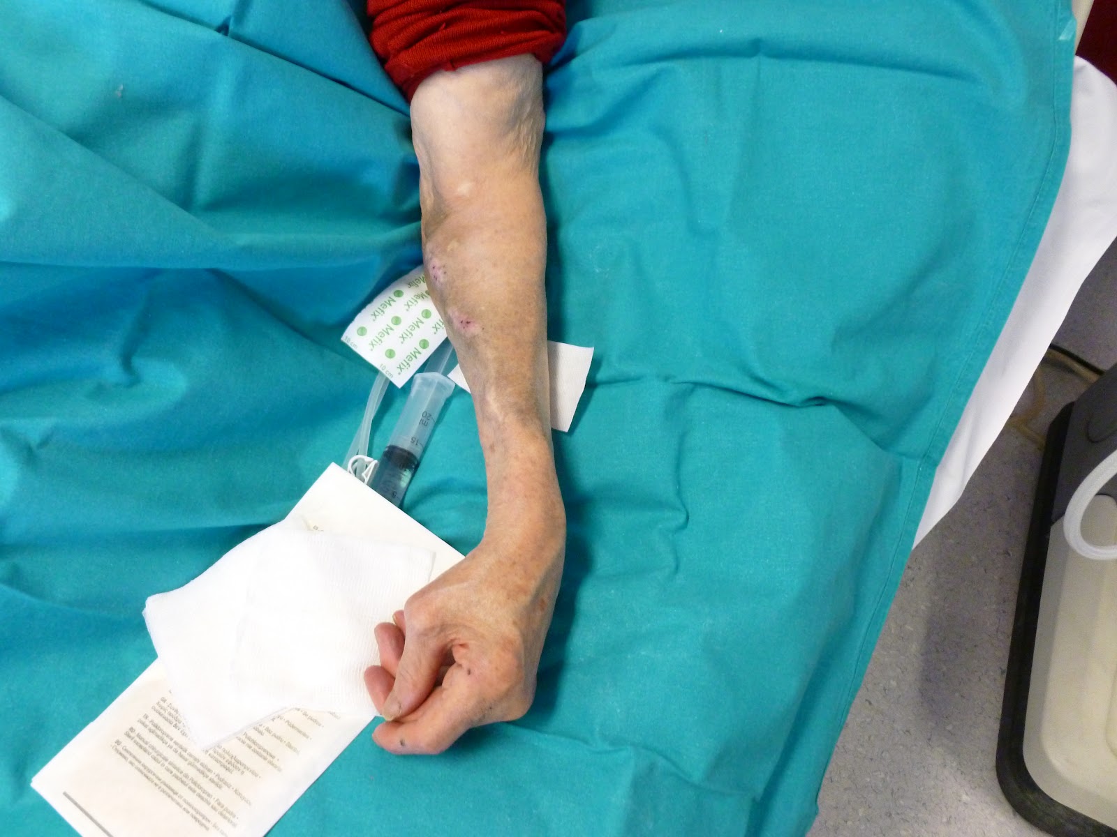 Nefrología para todos: la fístula de diálisis