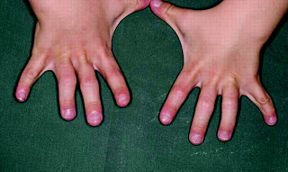 Enfermedades en la actualidad : Síndrome de Aase