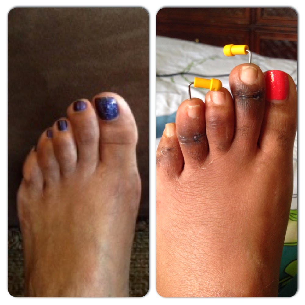 My Hammertoe & Tailors Bunion revision journey!