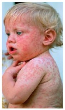 German Measles ~ All Tutorial Site