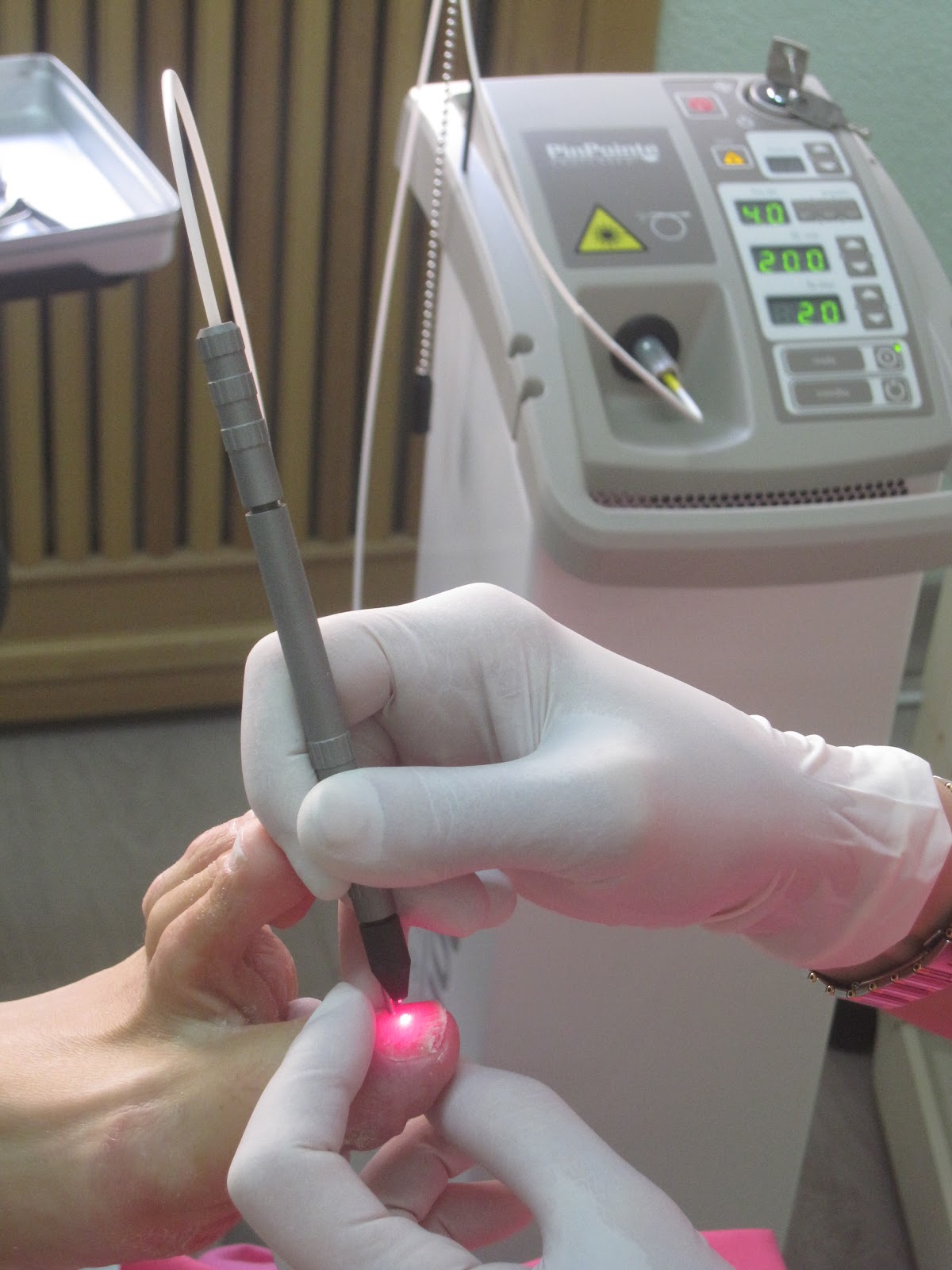 Podo Basas al Día: Onicomicosis varias con el PinPointe FootLáser ...