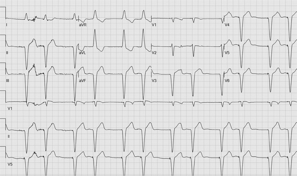 Focus on ECGs: Case #10 — Bigeminy and a Pacemaker