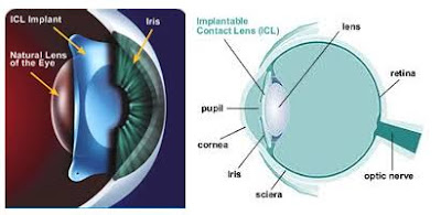 Keratoconushub: ICL LASIK INTACS