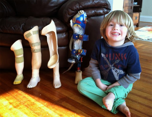 Prosthetics and Orthotics : PFFD เมื่อเด็กมีขาไม่ครบส่วน