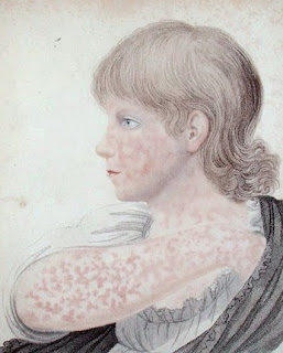 Un dermatólogo en el museo : Robert Willan, el primer dermatólogo?