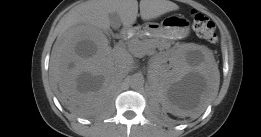 Roentgen Ray Reader: Rind-like Perirenal Soft-Tissue Masses