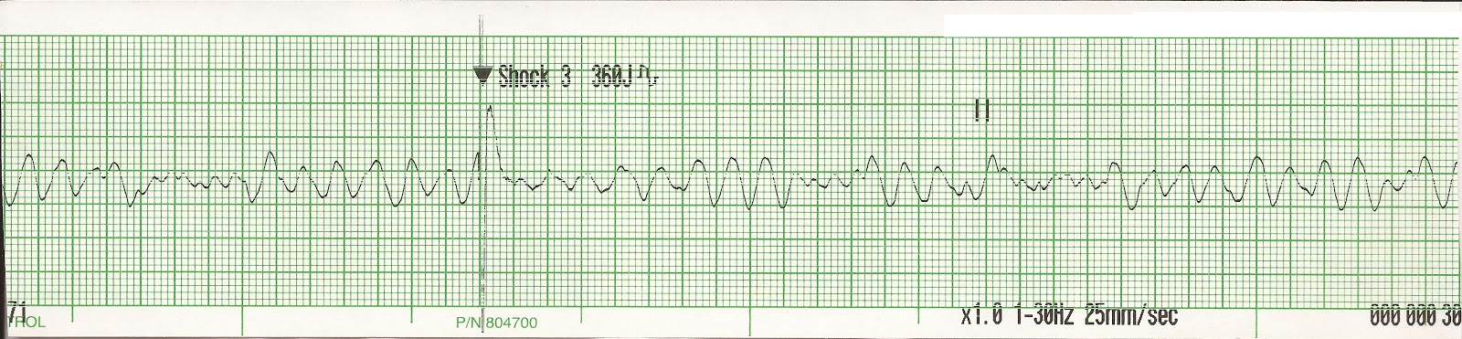 Float Nurse: Pulseless VF/VT