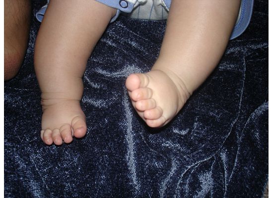 Our Clubfeet Course of Correction: The Beginning & How we arrived at ...