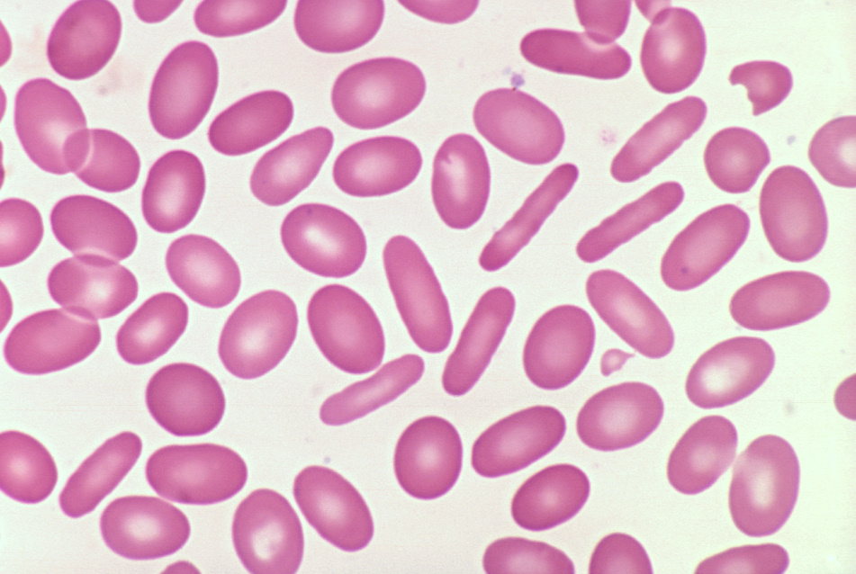 Study Medical Photos: Studying The Erythrocyte (RBC) Morphology On ...