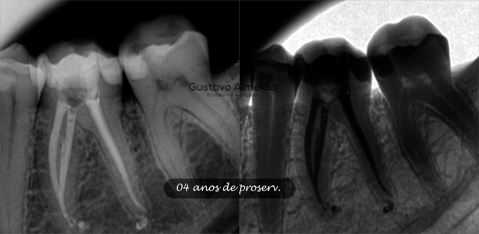 PERIODONTITE APICAL - (CASO DO DIA) | Endo Gustavo Almeida