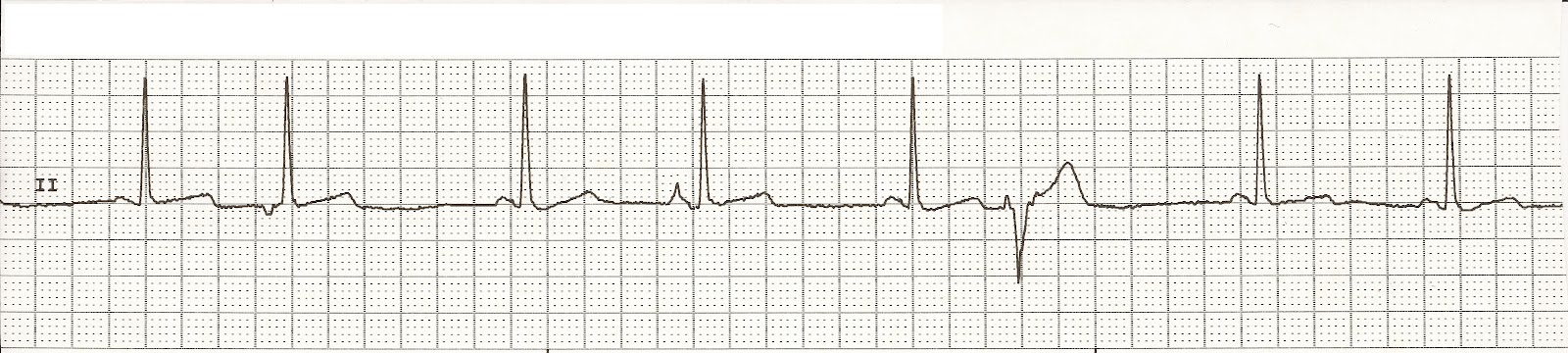 EKG Rhythm Strips 11- ectopic beats