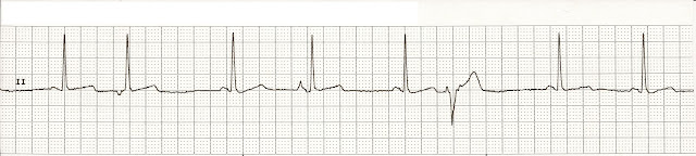 EKG Rhythm Strips 11- ectopic beats
