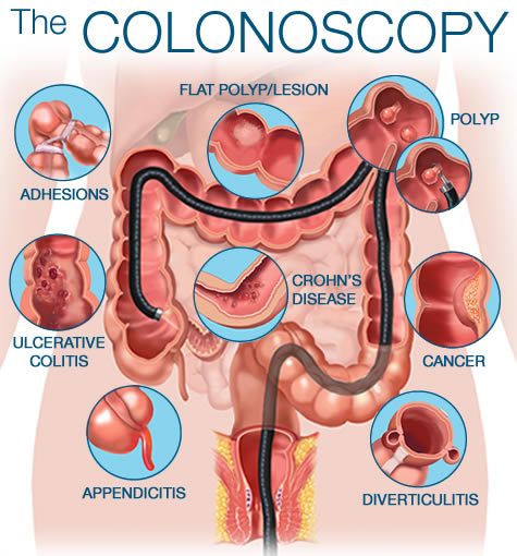 Diagnosis of ulcerative colitis - The colonoscopy is the main