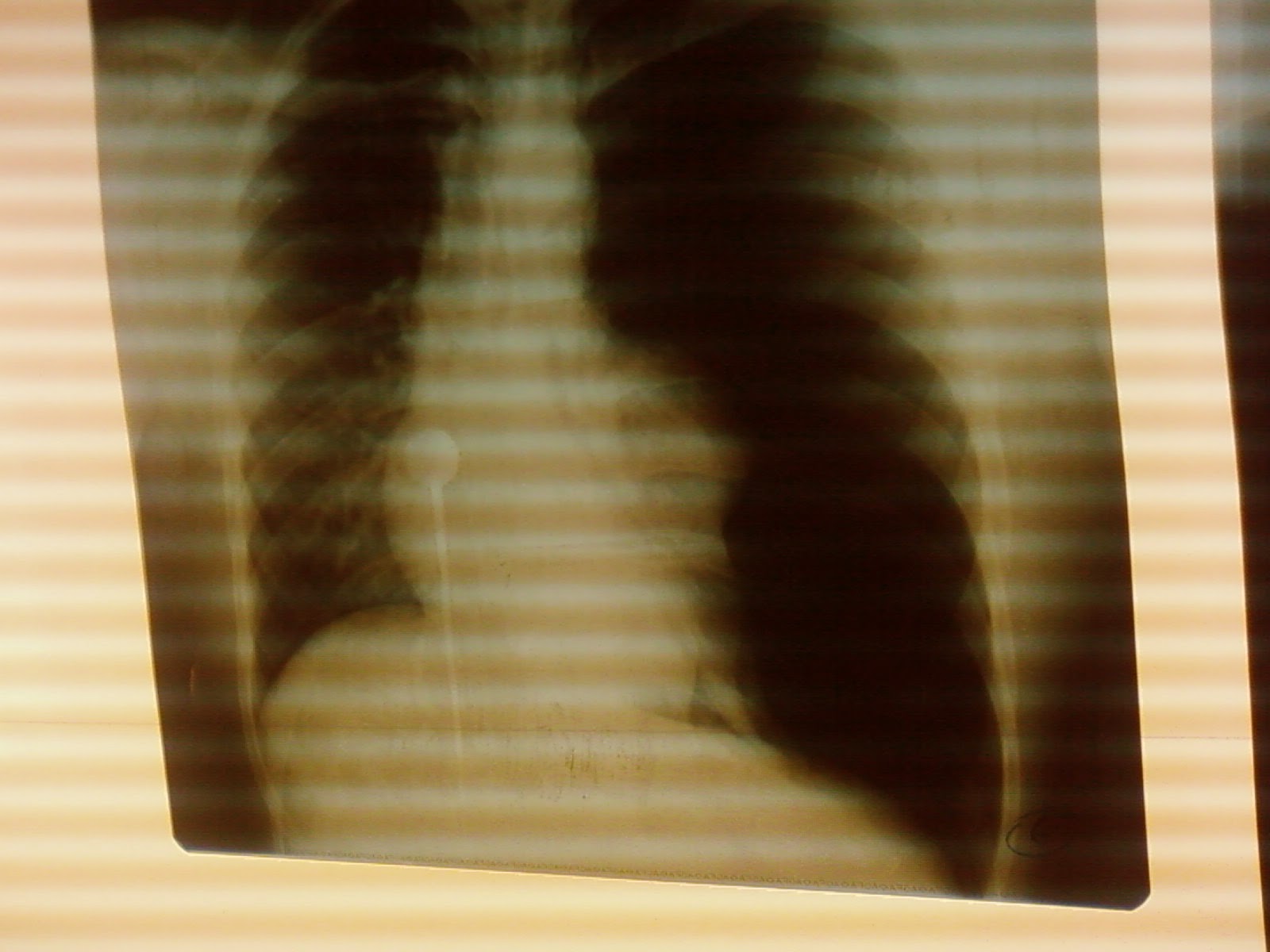 Telethorax
