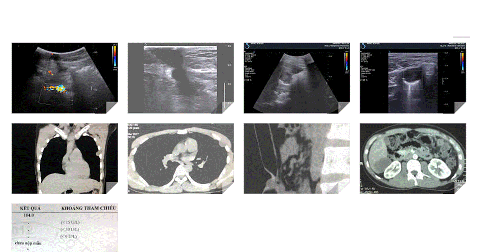 VIETNAMESE MEDIC ULTRASOUND: CASE 426: MULTIPLE TUBERCULOSIS ABSCESSES ...