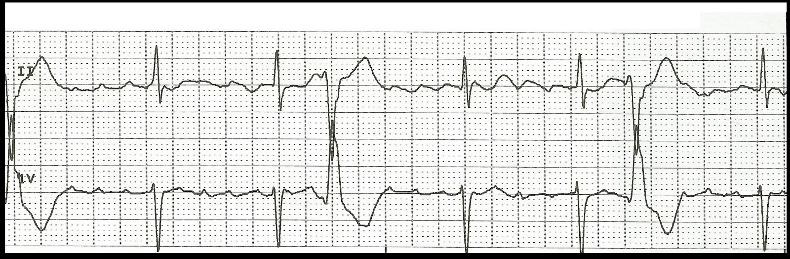 EKG Rhythm Strip Quiz 127