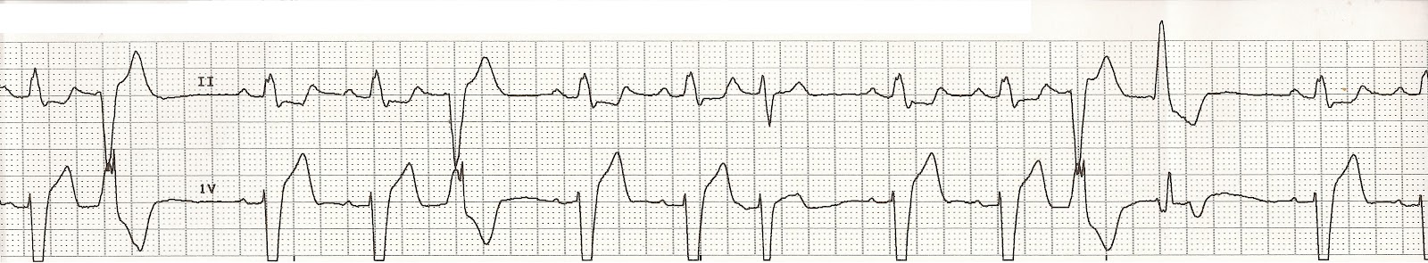 EKG Rhythm Strip Quiz 42