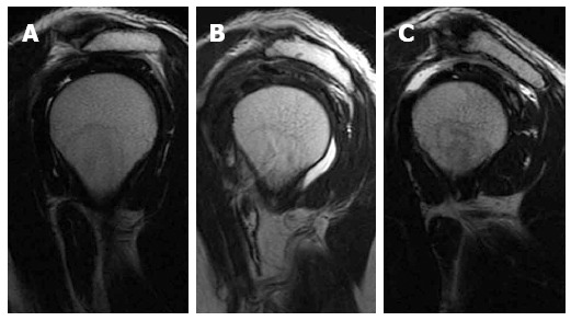 Acromion Types Mri Rotator Cuff Tear Patterns: MRI Appearance And Its