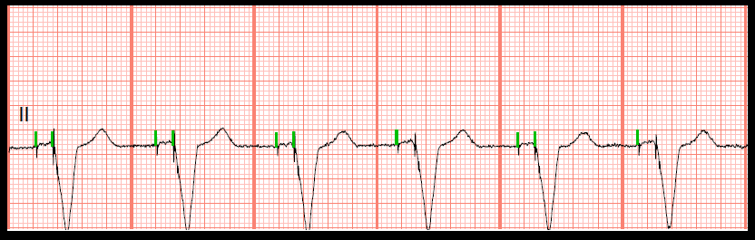 Practice EKG Strips