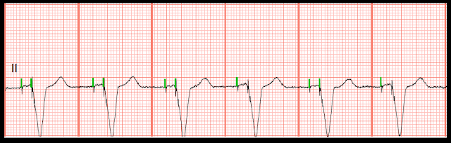 Practice EKG Strips