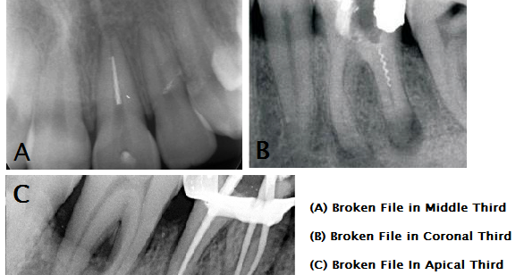 :: World Of Dentistry ::: Removal Of Separated Endodontic Files Inside ...