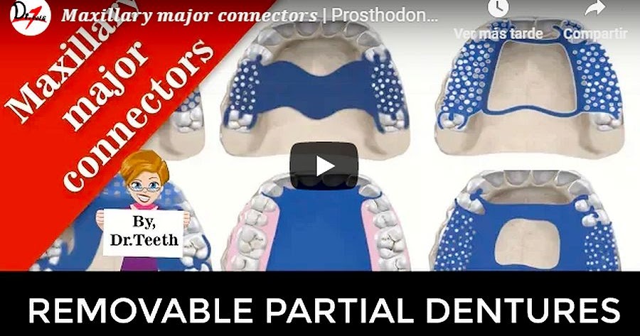 PROSTHODONTICS: Maxillary major connectors - Odonto-Tv