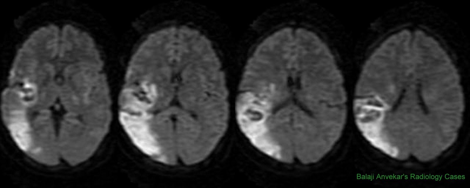 Dr Balaji Anvekar FRCR: Hyperperfusion Injury in Infarct
