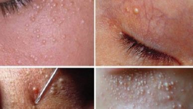 How to Remove the Small White Skin Cysts? - Useful info