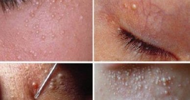 How to Remove the Small White Skin Cysts? - Useful info