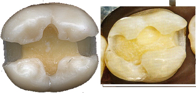Saúde da Boca: NOMENCLATURA E CLASSIFICAÇÃO DAS CAVIDADES