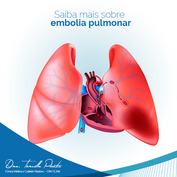 BLOG ENCONTRO COM A SAÚDE DE SOBRAL: Embolia Pulmonar - Drª Tarcilla ...