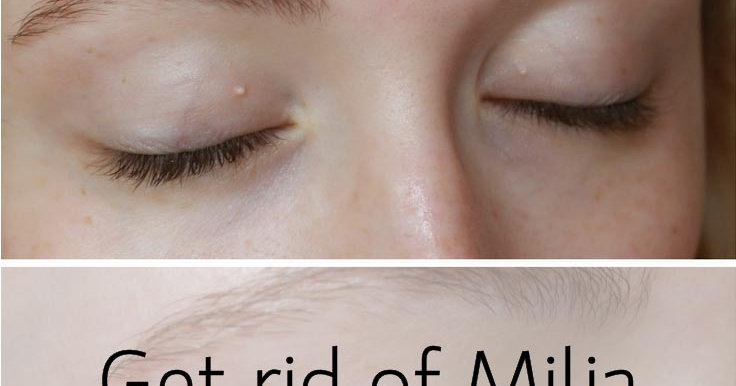 Milia removal – with no scars | HEALTHYLIFE