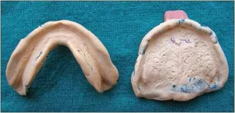 Ahmedabad dentist: WASH IMPRESSION