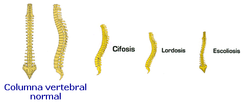 Clínica ARTHROS Vigo: Columna vertebral
