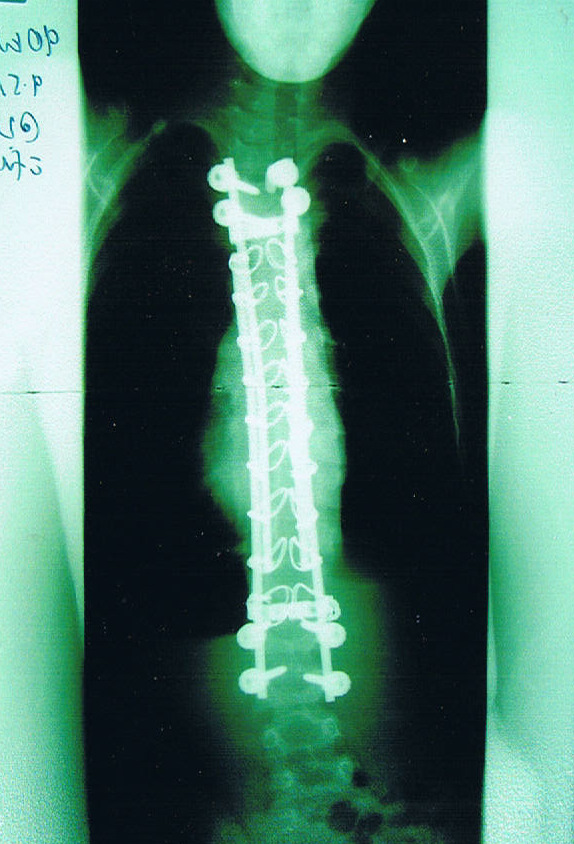 Life with Beals: Surgical Options