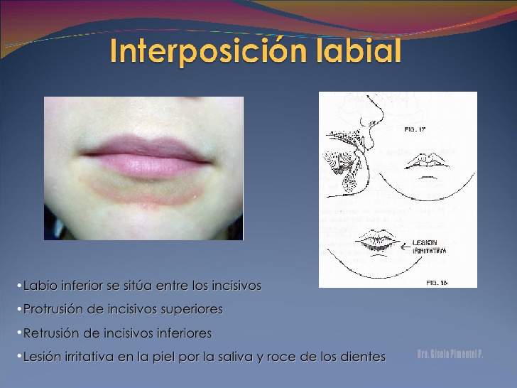 Informática salud publica: MALOS HÁBITOS BUCALES