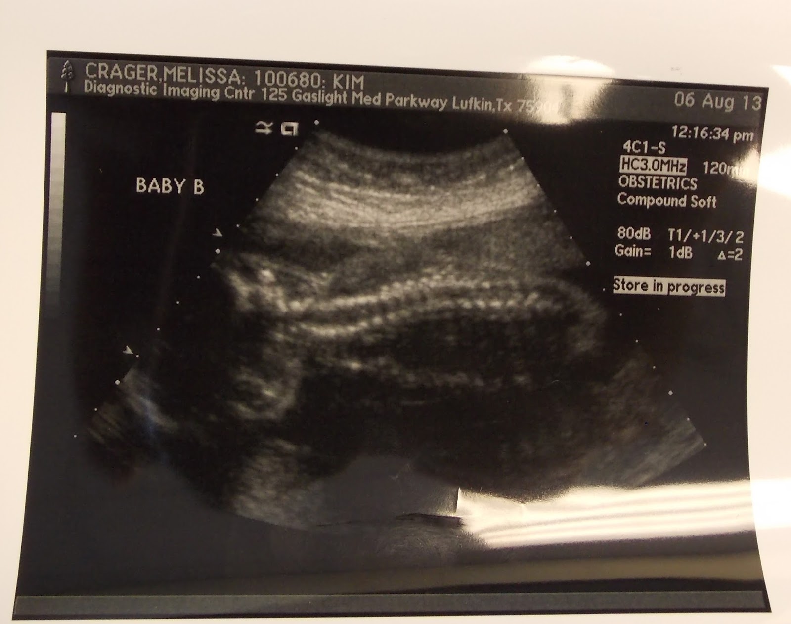 22 week ultrasound