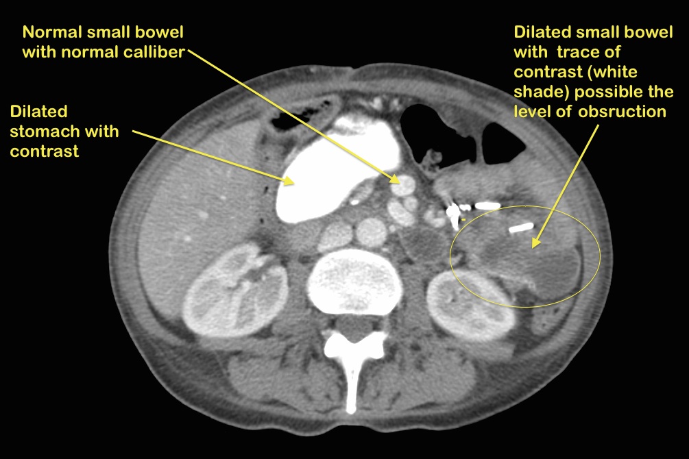upper GI Archives - DSSurgery
