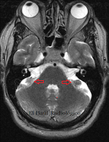 El Baúl Radiológico: LÓBULO FLOCULONODULAR CEREBELOSO. (The Cerebellar ...