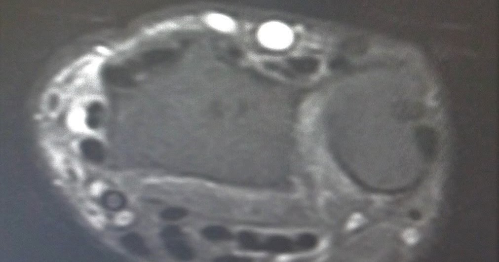 De Quervain Tenosynovitis: MRI - Sumer's Radiology Blog