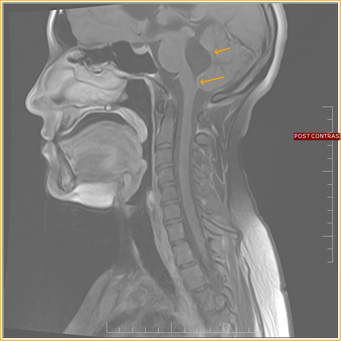Obstruction of Magendie's Foramen :MRI - Sumer's Radiology Blog