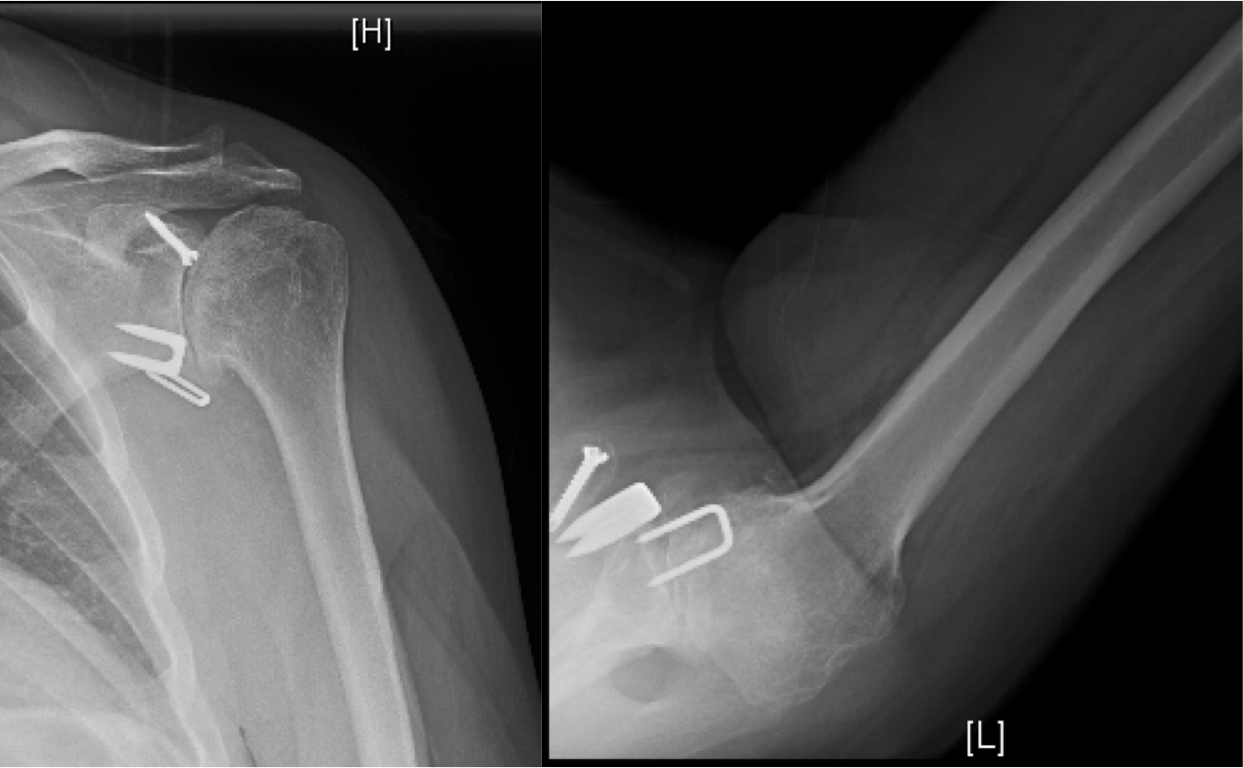 UW Shoulder and Elbow Academy: Ream and Run for Capsulorrhaphy ...
