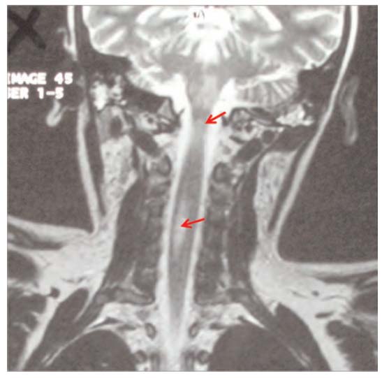 Medical: akute disseminierte Enzephalomyelitis Infektion durch ...