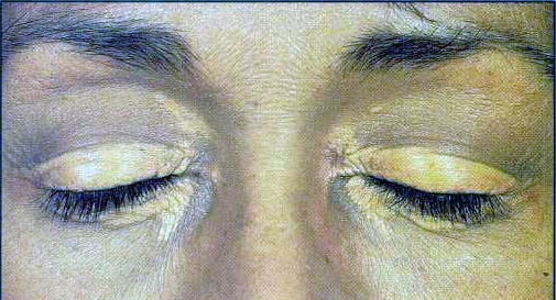 Tendon Xanthomata Rated Medicine