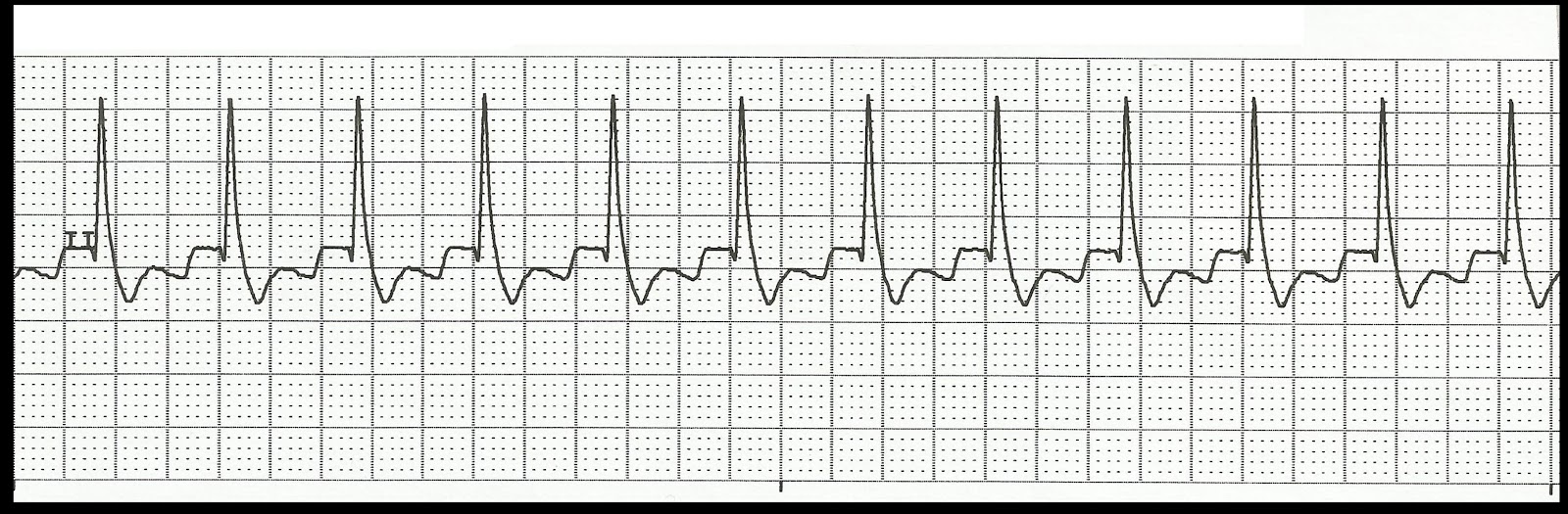 Basic ECG Rhythm Test 05