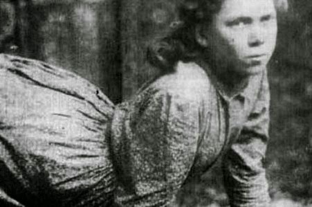 ΑΠΙΣΤΕΥΤΕΣ ΕΙΚΟΝΕΣ: Άνθρωποι με τρομερές γεννητικές ανωμαλίες που δεν ...