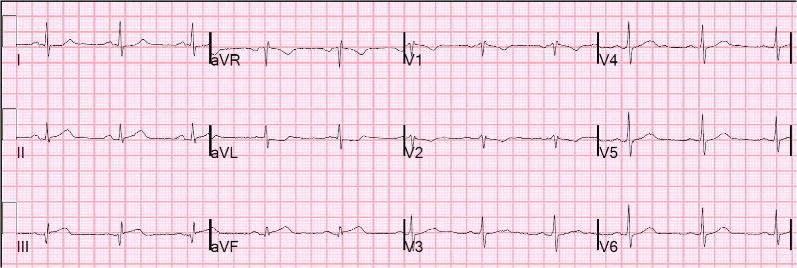 Dr. Smith's ECG Blog: Dynamic inferior MI: STEMI or Non-STEMI? Does it ...