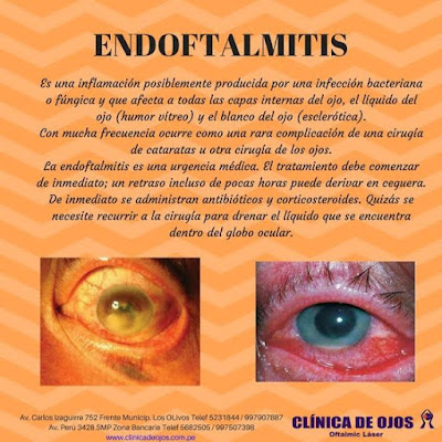 Clínica de Ojos Oftalmic Láser: ENDOFTALMITIS
